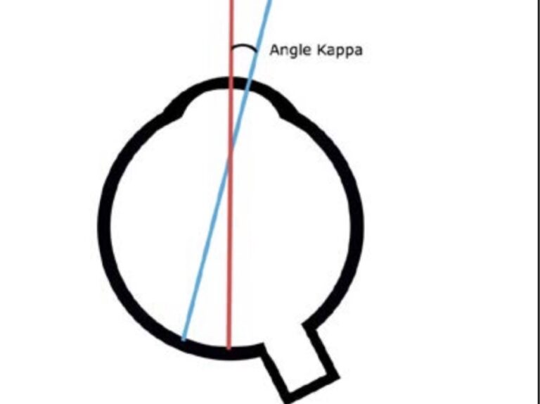 IMPORTÂNCIA DO ÂNGULO KAPPA NO POSICIONAMENTO DA LIO, POR CAROLINA ...