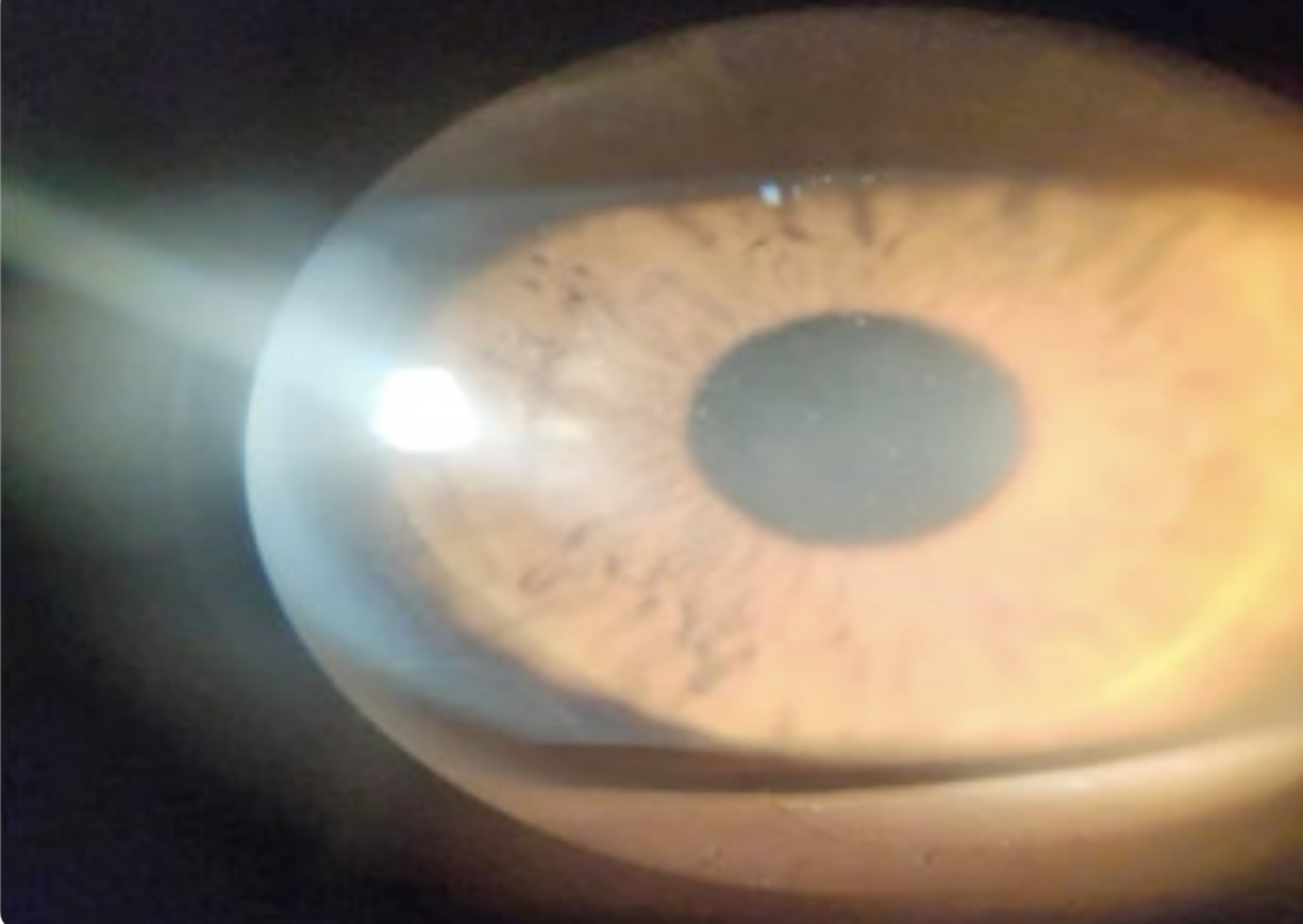 IMPLANTE DE XENIA - TÉCNICA GHABRA, POR MARWAN GHABRA - Oftalmologia em ...